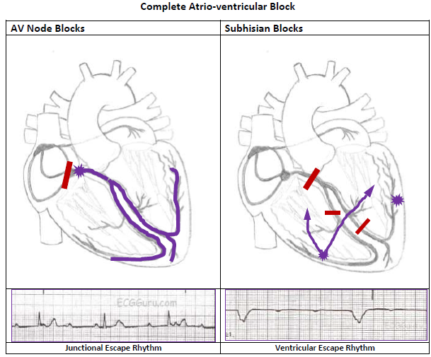 Two Types of Complete Heart Block | ECG Guru - Instructor Resources Two Types of Complete Heart Block | ECG Guru - Instructor Resources